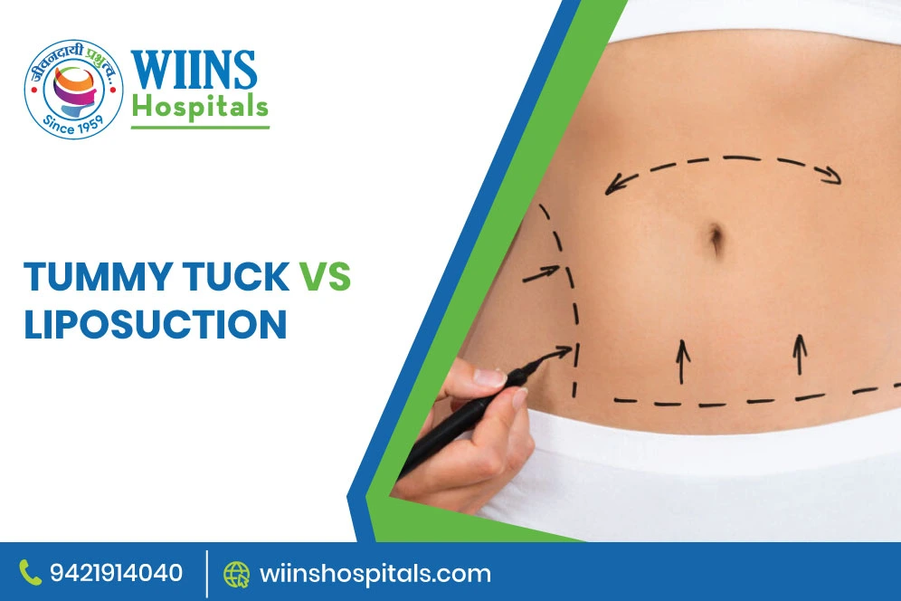 Tummy Tuck Vs Liposuction 5223